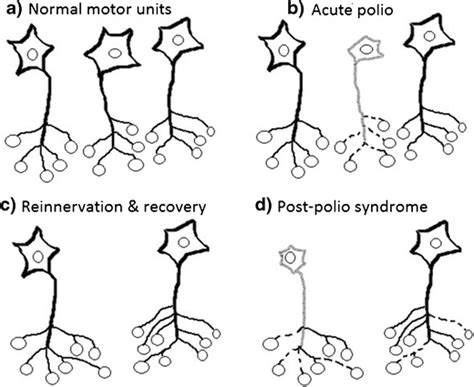 Pathophysiology Of Post Polio Syndrome A A Motor Unit Is Made Of A