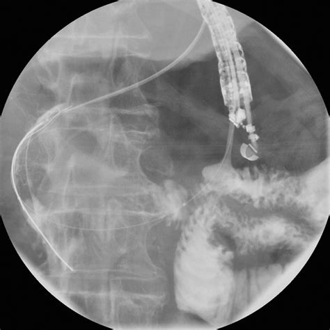 Fluoroscopic View Showing Lumen Apposing Stent Deployment Download Scientific Diagram