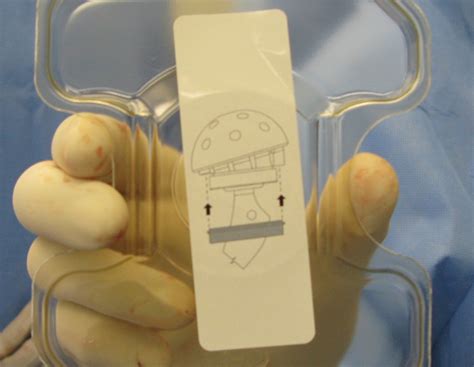 Técnica De Revisão De Prótese Infectada Do Quadril