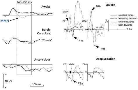 Mismatch Negativity Mmn And P300 In Anesthesia A Mmn Elicited At