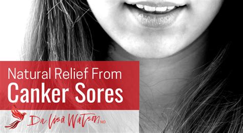 Natural Relief From Canker Sores Dr Lisa Watson