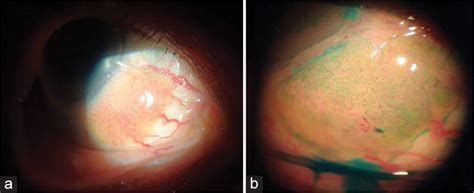 Topical 5 Fluorouracil As Monotherapy For Ocular Surface Squamous