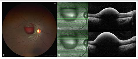 Figure 2 From Inverse Drainage Ndyag Membranotomy For Pre Macular