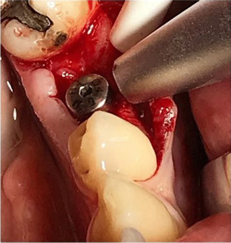Measuring Of The Primary Stability Immediately After Implant Insertion