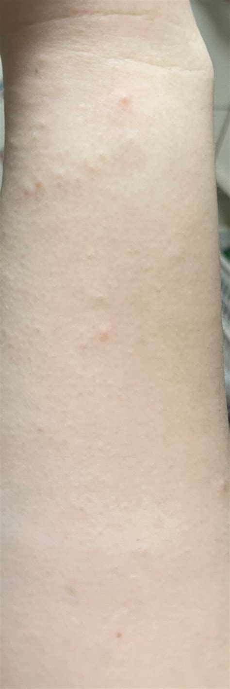 샤워 후 두드러기 지식in