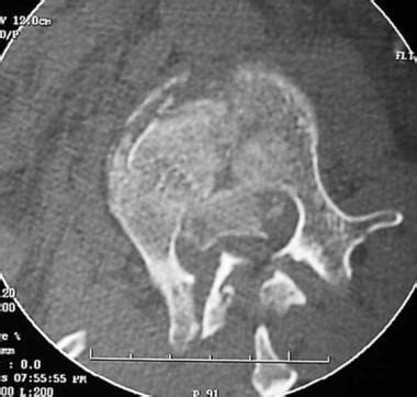 Thoracic Spine Fractures And Dislocations Treatment Management