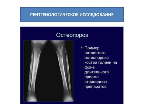 Остеопороз - презентация онлайн