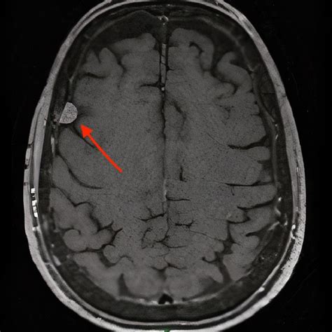 Gadolinium Enhanced T1 Weighted Magnetic Resonance Imaging Right
