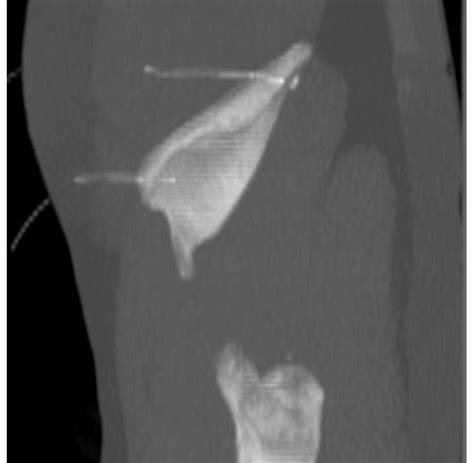 Pre Operative Targeting Of The Metastasis Using Hook Wires Placed