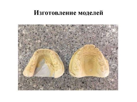 Изготовление полного съемного протеза на нижнюю челюсть - online ...