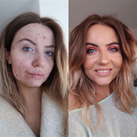 This Foundation Is Going Viral After Cystic Acne Sufferer Shares Her