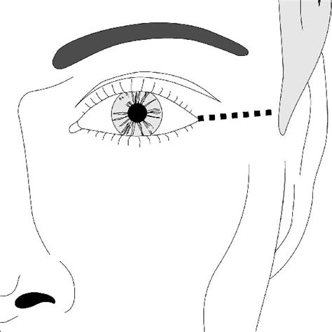 1 Lateral Canthotomy Emergent Procedure To Relieve Orbital Compartment