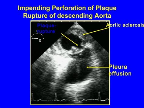 Aortic Ulcer Intramural Hematoma Aortic Dissection Ppt