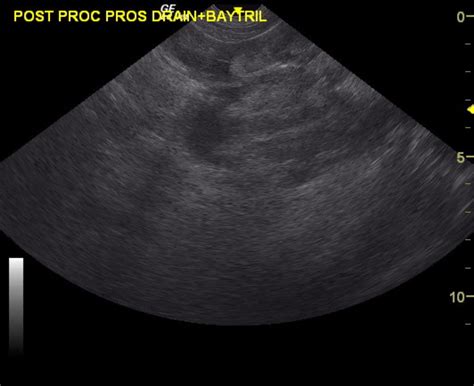 09 00174 Gus S Prostatic Cyst Members