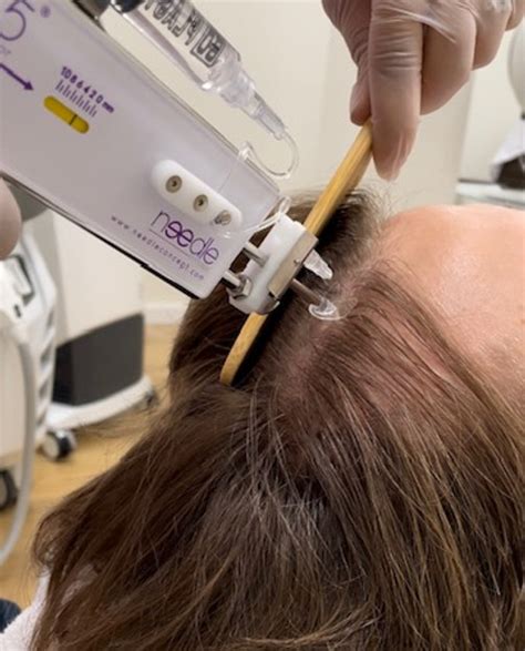 Haaruitval Behandeling In Apeldoorn Care Clinic
