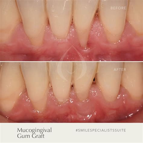 Periodontal Before And After Results Smile Gallery