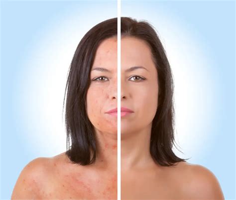 Pico Lasers Top Med World