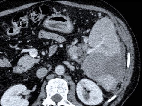 Figure 13 From Splenic Cystic Lesions Differential Diagnosis