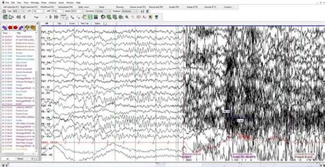 Understanding Frontal Lobe Seizures