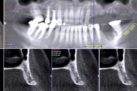 Bone And Soft Tissue Augmentation For Implant Supported Restoration Of