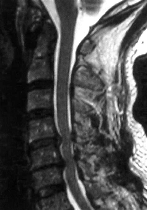 Adult Pyogenic Vertebral Osteomyelitis Spine Orthobullets