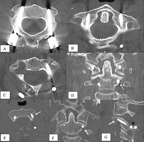 A Axial View Of C2 Pedicle Screw Placement Grade 0 On Both Sides