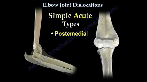 Elbow Dislocation Carolina Regional Orthopedics