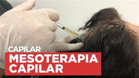 Mesoterapia En El Cuero Cabelludo ¿cómo Funciona Actualizado Junio 2025