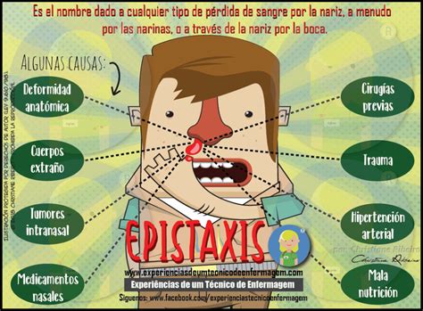 La Epistaxis ¿qué Es Enfermagem Ilustrada