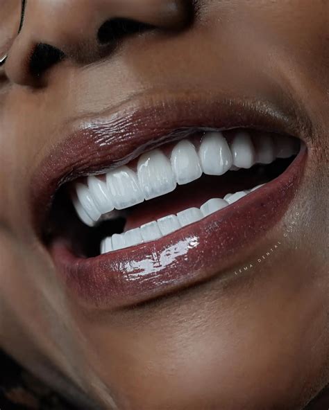 Patient Stories And Reviews Lema Dental Clinic Istanbul
