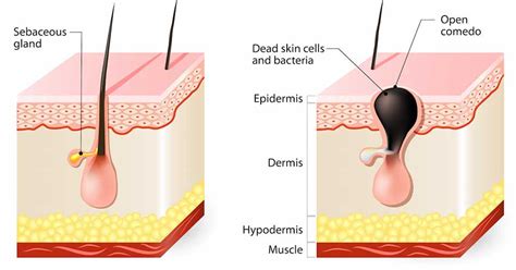 Clogged Armpit Sweat Glands Heres How To Manage Them Miradry Miami