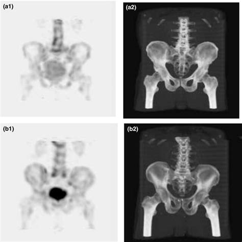 Patient From Group I A1 Spect A2 Ct Patient From Group Ii B1