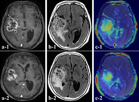 Representative View Of The Amide Proton Transfer Apt Imaging Of