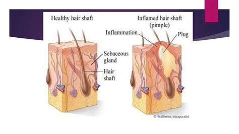 Psoriasis And Acne Vulgarispptx Integumentary System Ppt