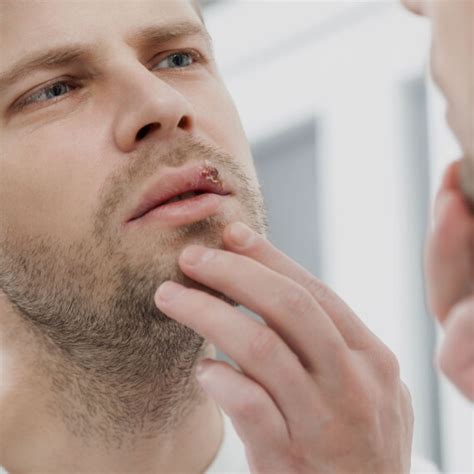 Why Do I Keep Getting Recurring Cold Sores Compeed