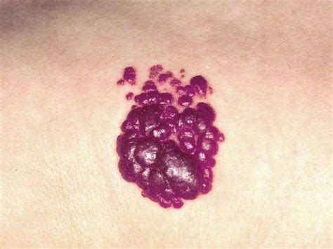 Cutaneous Vascular Lesions Pptx