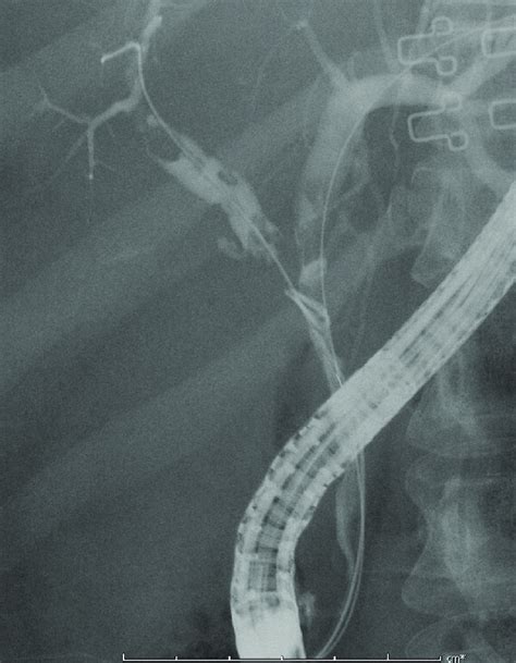 present cholangiogram showing persistent perihilar stricture involving