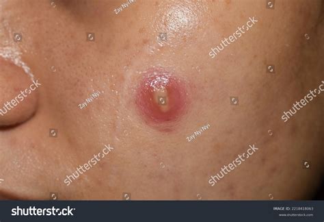 Pustule Skin Lesion