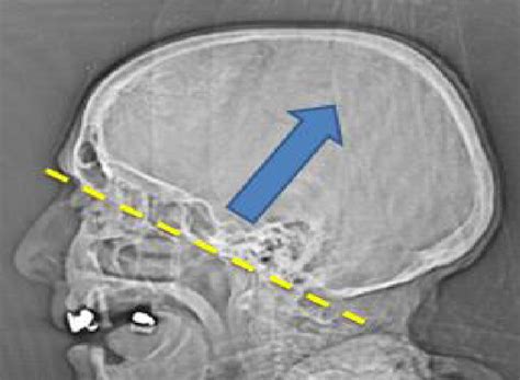 A Ct Topogram Showing How The Brain Should Be Reconstructed According