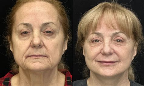 Facelift Results 3 Weeks Into Recovery