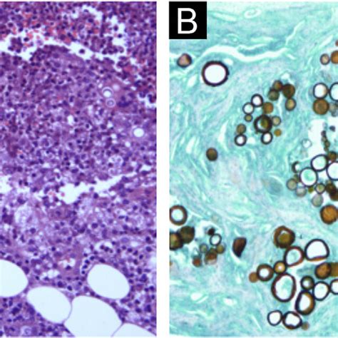 A Hematoxylin And Eosin Staining Chronic Granulomatous Inflammation