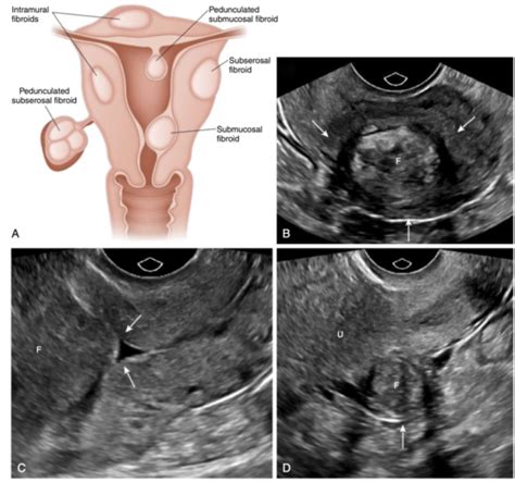 Pelvic Imaging Flashcards Quizlet