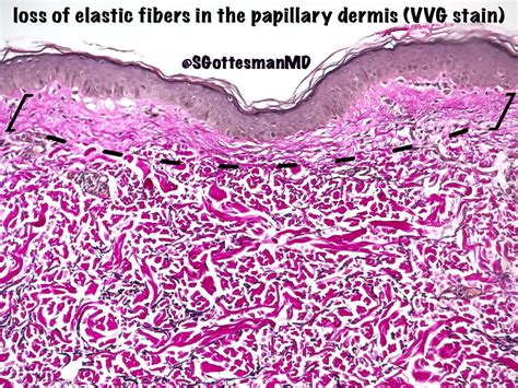 Elastic Stains Normal Skin Elastic Stains Normal Skin