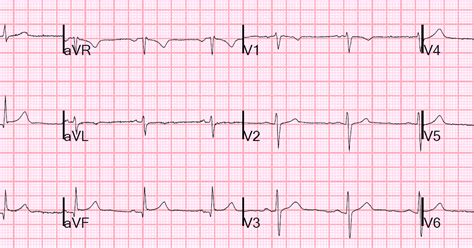 Dr Smiths Ecg Blog St Elevation Inferior Mi Or Early Repol Ultrasound Speckle Tracking Can