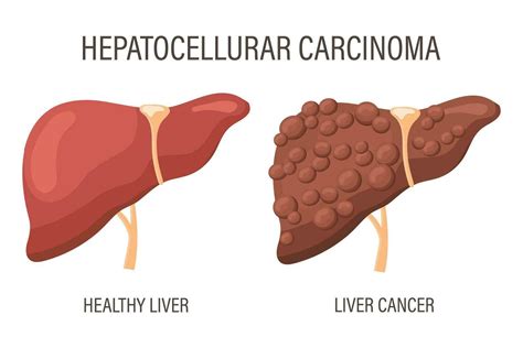 hepatocelular carcinoma hígado enfermedades sano hígado y hígado
