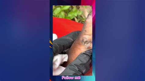 Jiggers Remove 1003 Youtube