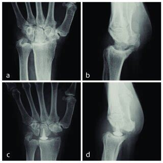 CT Scans Before RCPI Implantation A B And Radiographies After RCPI Download Scientific