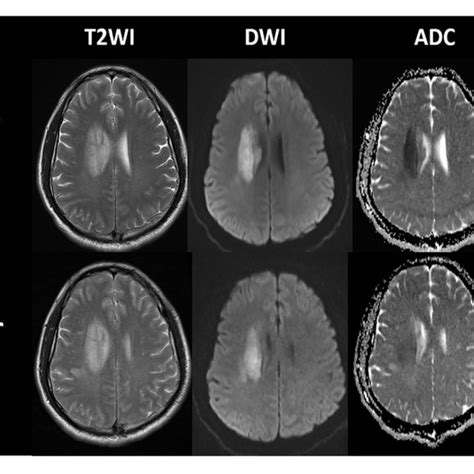 Time Course Of The Signal Intensities In T2 Weighted Imaging T2wi