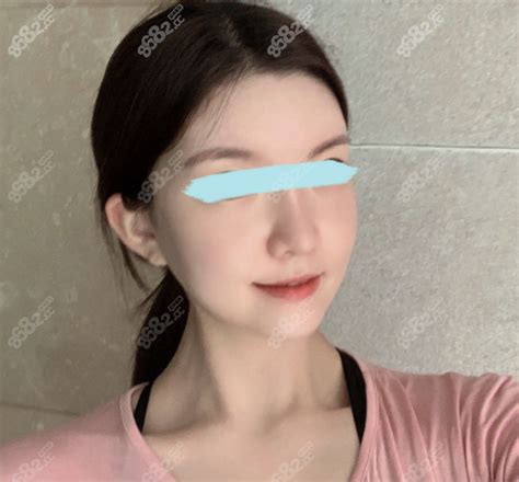 韩国菲斯莱茵做得好吗听听整容者怎么评价菲斯莱茵的口碑口唇对比照 8682整形网
