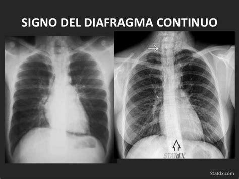 Neumotorax Y Neumomediastino